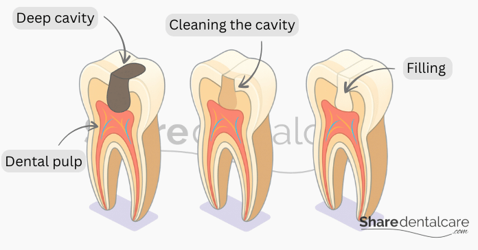 Root Canal Alternative: Options Instead of Root Canal Therapy - Share ...