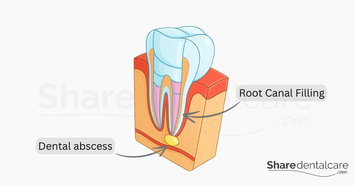 Root Canal Failure: Signs of a Failed Root Canal and How to Fix It ...