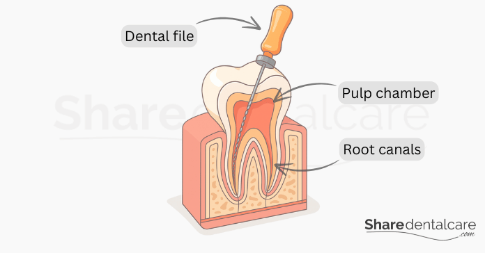 Root Canal on Crowned Tooth: Is it Possible, Risks, & Alternatives ...
