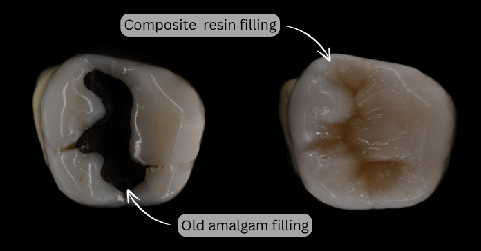 How Long Do Fillings Last? Lifespan, Types, and Tips for Longevity ...