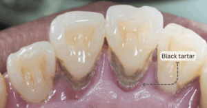 How to Remove Black Tartar from Teeth: Remove Tartar at Home - Share ...