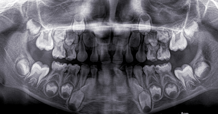 Baby Teeth X-Ray: Why Pediatric Dental X-Rays Are Necessary? - Share ...
