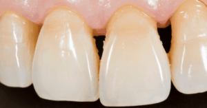 Teeth Tartar: Causes and How to Remove Dental Plaque and Tartar - Share ...