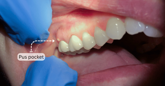 Root Canal Infection Years Later: Why Old Root Canal Hurts Again ...