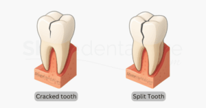 Cracked Molar: Causes, Symptoms, and How to Fix Cracked Teeth - Share ...