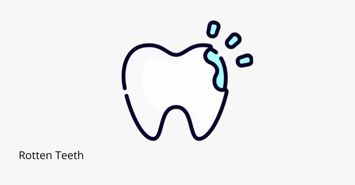 Rotten Teeth: Signs of Tooth Decay and Cavity Treatment Options - Share ...
