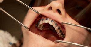 Palate Expander: How a Palatal Expander Widens the Upper Jaw - Share ...