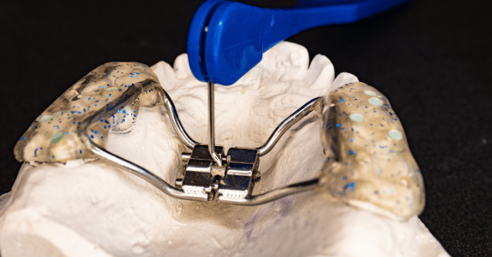 Palatal Expanders: A Guide to Palatal Expansion in Orthodontics - Share ...