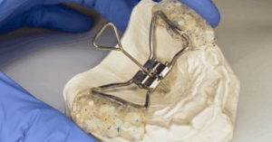 Palate Expander: How a Palatal Expander Widens the Upper Jaw - Share ...