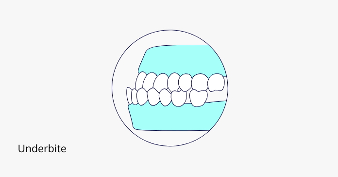 Underbite: Causes and Underbite Correction Treatment Explained - Share ...