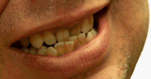 Underbite: Causes and Underbite Correction Treatment Explained - Share ...