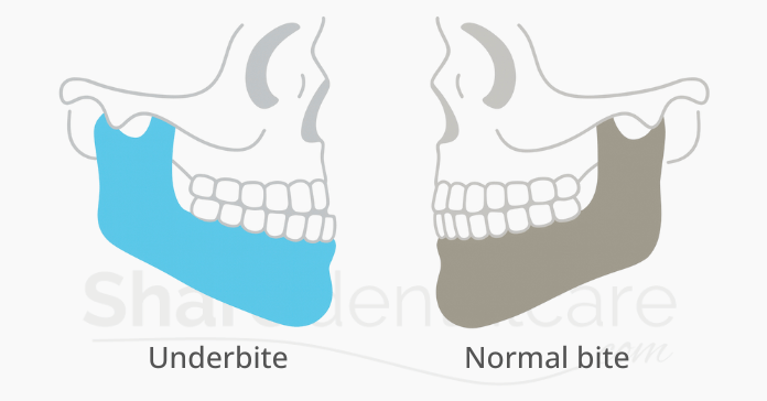 Underbite: Causes and Underbite Correction Treatment Explained - Share ...