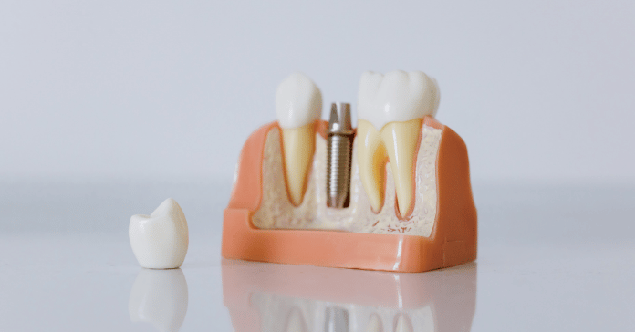 Bone Graft in Tooth: A Guide to Dental Bone Grafting for Implants ...