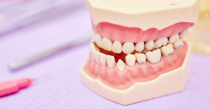 Underbite: Causes and Underbite Correction Treatment Explained - Share ...