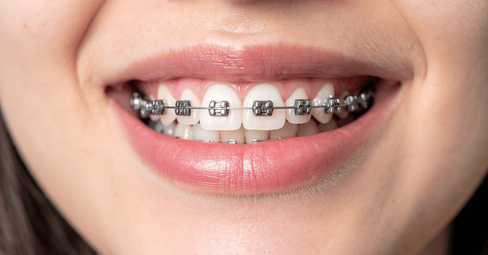 Dental Braces: How Orthodontics Work to Straighten Your Teeth - Share ...