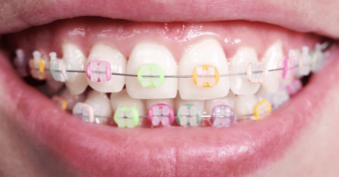 Braces Colors: How to Choose the Best Shade for Your Smile - Share ...