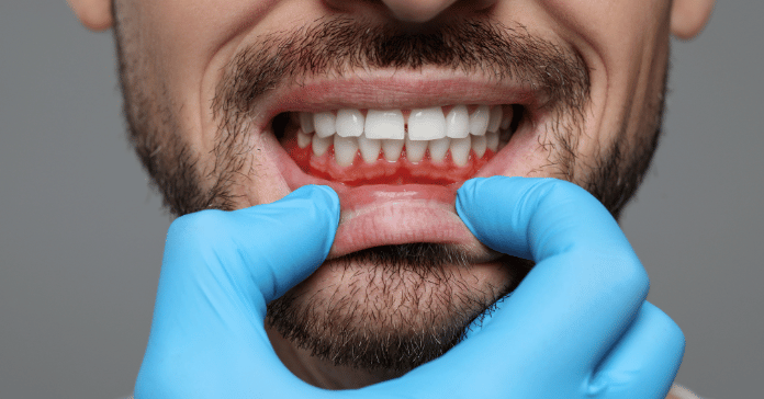 Blood from Gums: Causes and How to Stop Bleeding Gums - Share Dental Care