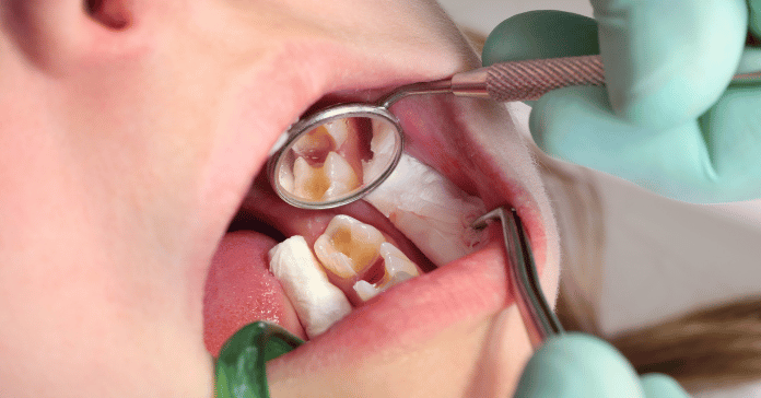 How Long Does a Cavity Filling Take? Dental Filling Timeline - Share ...