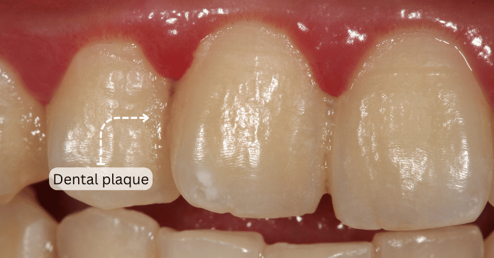 Tartar vs Plaque: How Dental Plaque Turns Into Tartar Buildup - Share ...