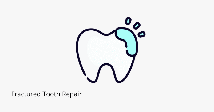 Fractured Tooth Repair: How to Fix a Chipped or Broken Tooth - Share ...