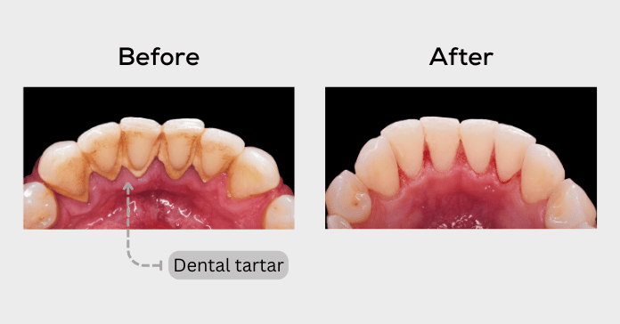 Tartar vs Plaque: How Dental Plaque Turns Into Tartar Buildup - Share ...