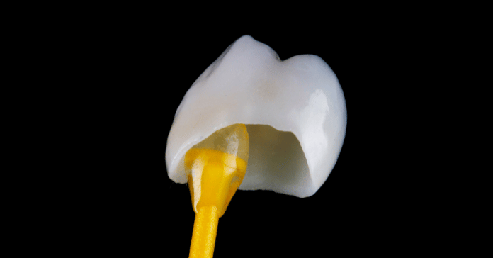 How Long Does a Cavity Filling Take? Dental Filling Timeline - Share ...