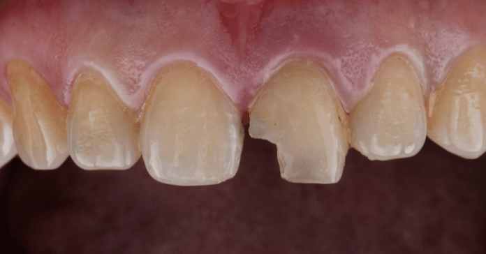 Tooth Decay in Front Teeth: Why Cavities Form and How to Treat - Share ...