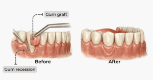 Gingival Recession Treatments: Options for Receding Gums - Share Dental ...