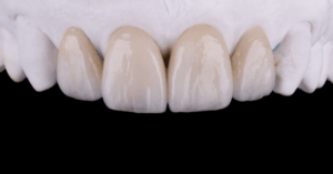 Tooth Decay in Front Teeth: Why Cavities Form and How to Treat - Share ...