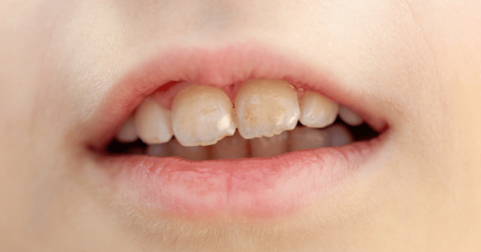 Stages of Tooth Decay: How Cavities Develop Step By Step - Share Dental ...