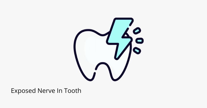 Exposed Nerve In Tooth: Normal Sensitivity Or Nerve Pain - Share Dental ...