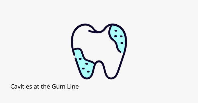 Cavities at Gum Line: Causes, Early Signs, and What to Do Next - Share ...