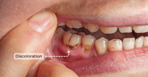 Cavities at Gum Line: Causes, Early Signs, and What to Do Next - Share ...