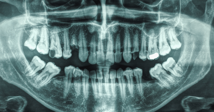 Exposed Nerve In Tooth: Normal Sensitivity Or Nerve Pain - Share Dental ...