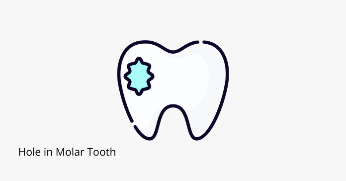 Hole in Molar Tooth: Is It a Cavity — or Something Else? - Share Dental ...